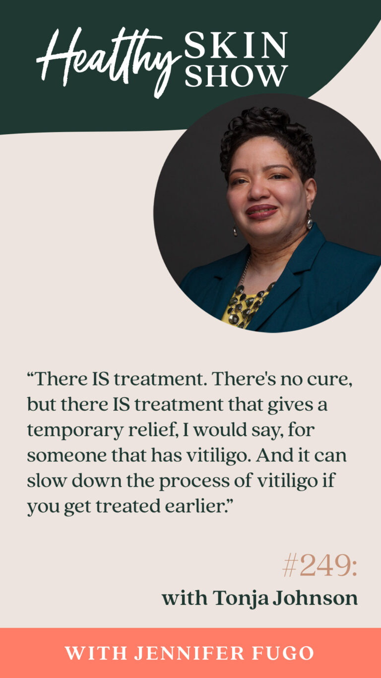 249: Inspiring Vitiligo Personal Journey w/ Tonja Johnson